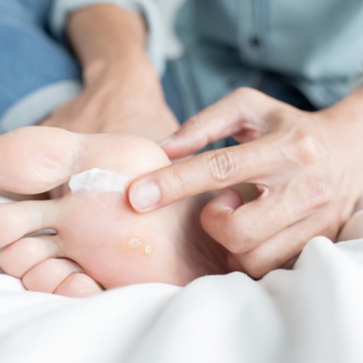 How To Prevent Diabetic Foot Fungal Infections?